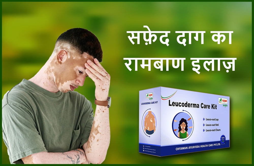 Leucoderma | Vitiligo | Safed Daag Ayurvedic Medicine and Treatment