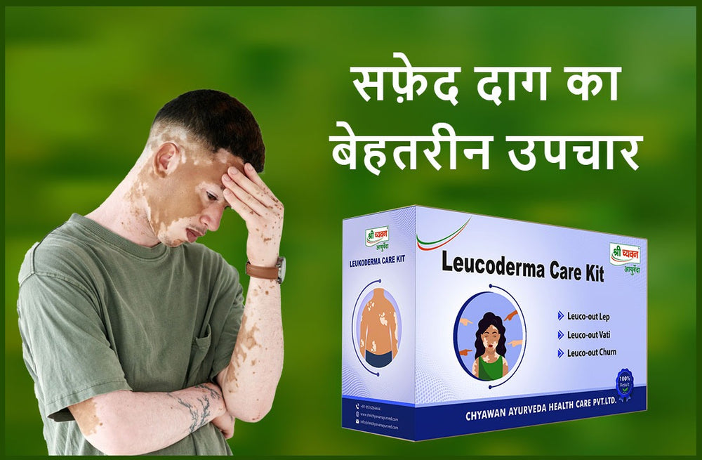 Leucoderma | Vitiligo | Safed Daag Ayurvedic Medicine and Treatment